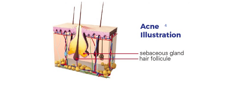 Acne (Pimples) - Articles | Dis-Chem